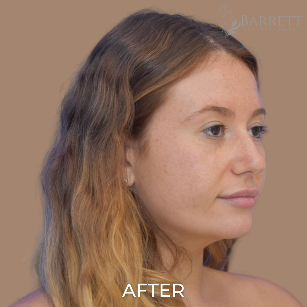 Natural Looking Lips – Barrett Beverly Hills specializes in natural ...