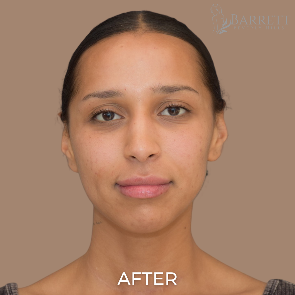 Natural Looking Lips – Barrett Beverly Hills specializes in natural ...