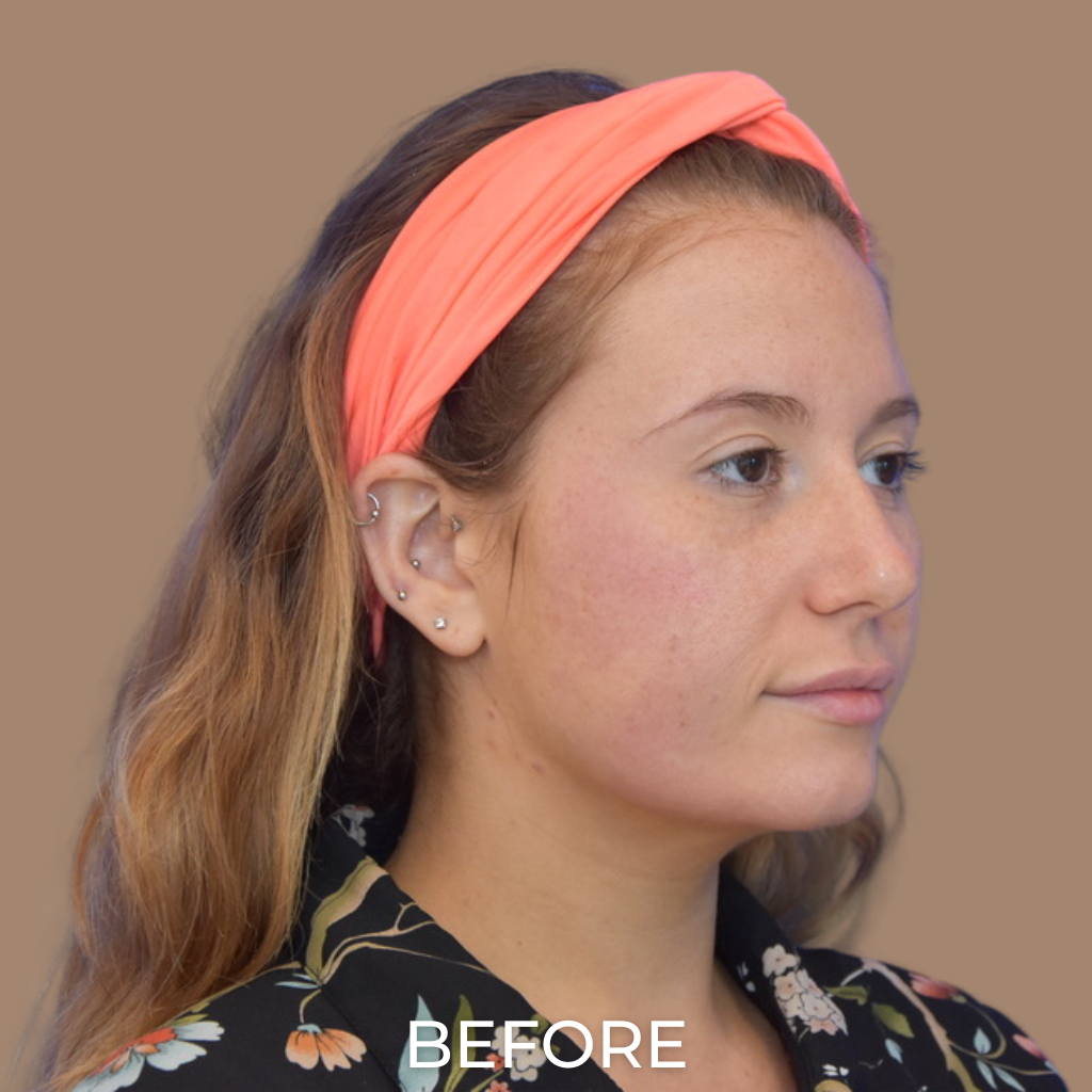 Natural Looking Lips – Barrett Beverly Hills specializes in natural ...