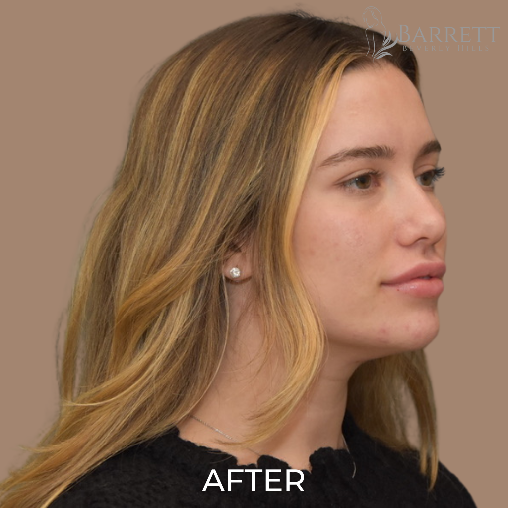 Natural Looking Lips – Barrett Beverly Hills specializes in natural ...