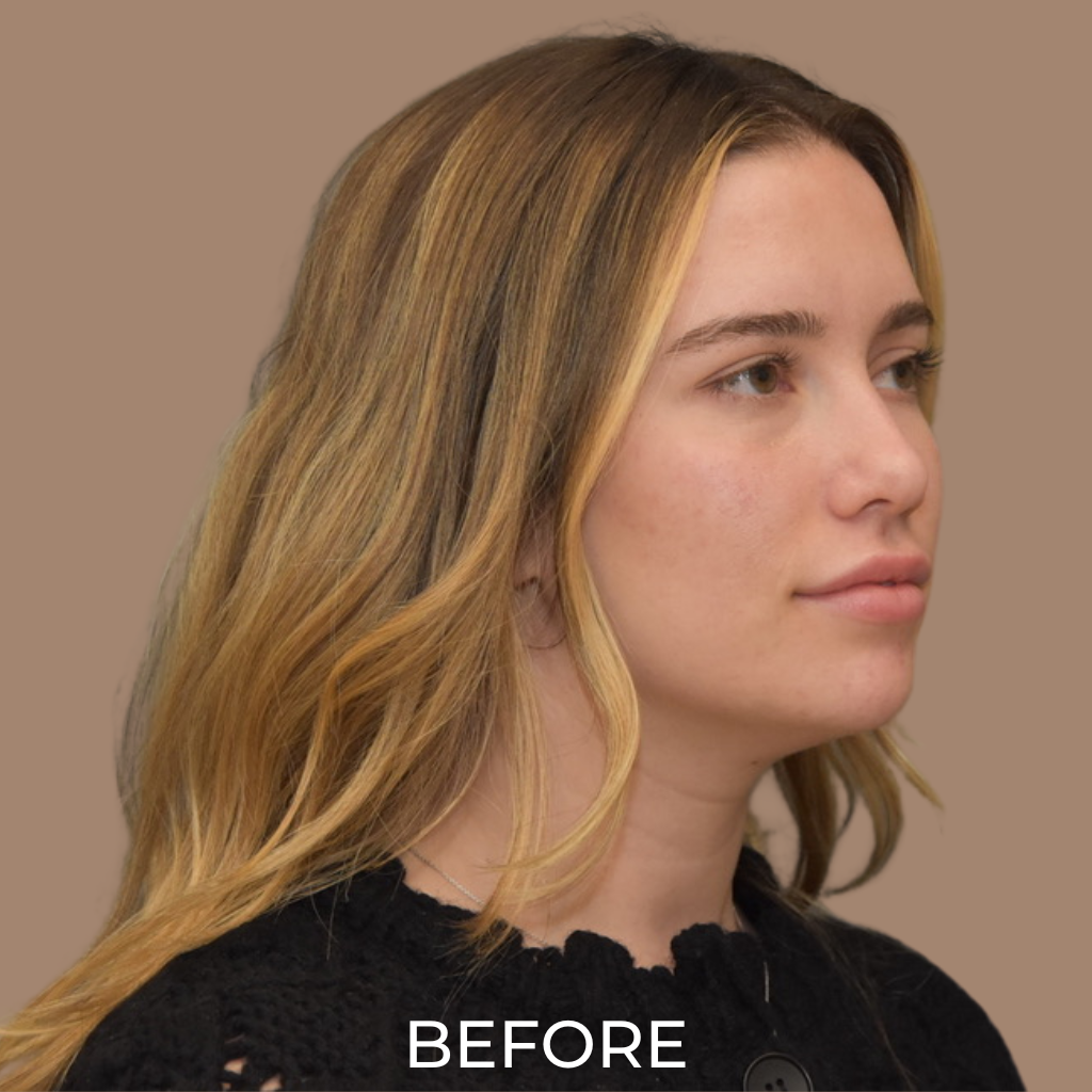 Natural Looking Lips – Barrett Beverly Hills specializes in natural ...