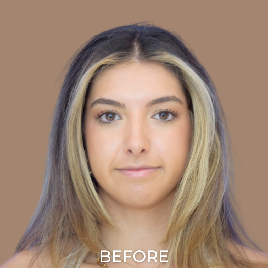 Natural Looking Lips – Barrett Beverly Hills specializes in natural ...