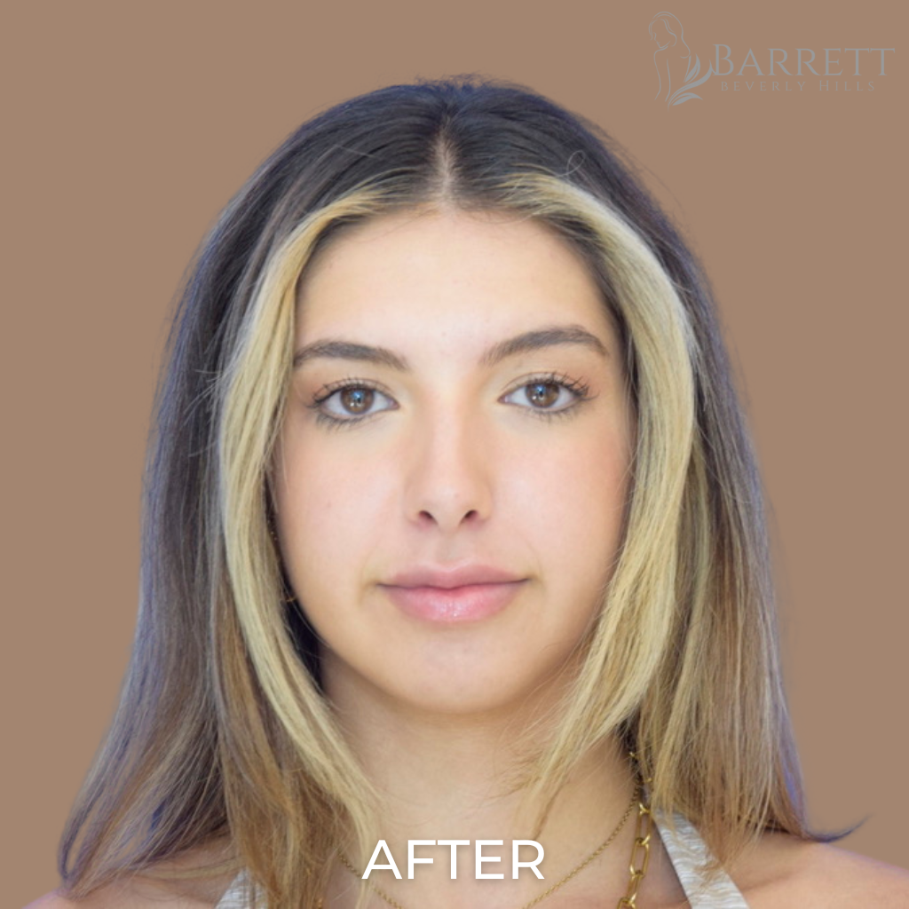 Natural Looking Lips – Barrett Beverly Hills specializes in natural ...