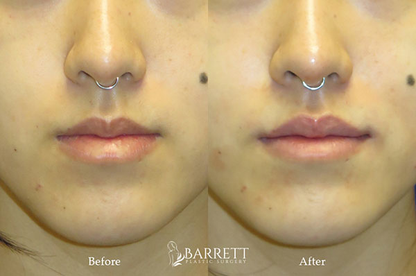 Natural Looking Lips – Dr. Barrett is a fully licensed plastic surgeon ...