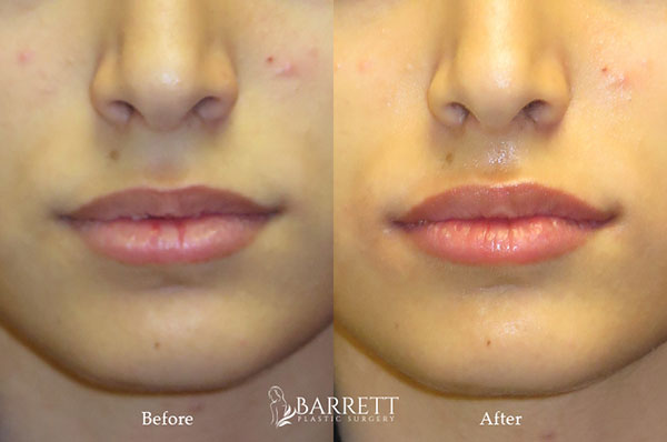 Natural Looking Lips – Dr. Barrett is a fully licensed plastic surgeon ...